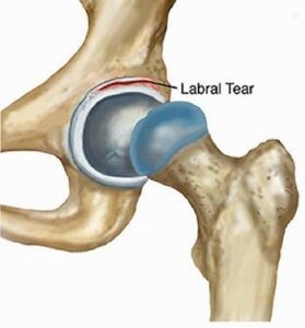 Labral Tear Treatment in NJ | Pain Management Doctors