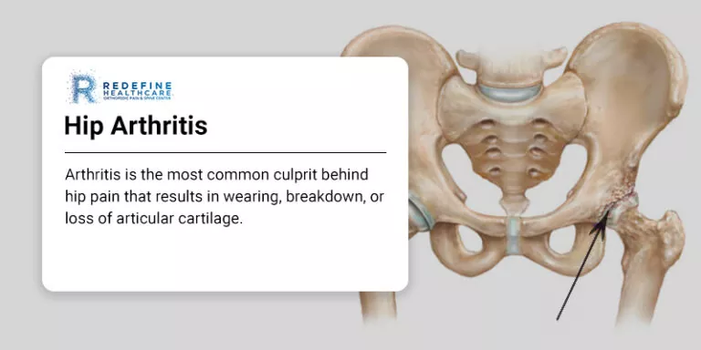 Hip Arthritis - NJ's Top Orthopedic Spine & Pain Management Center