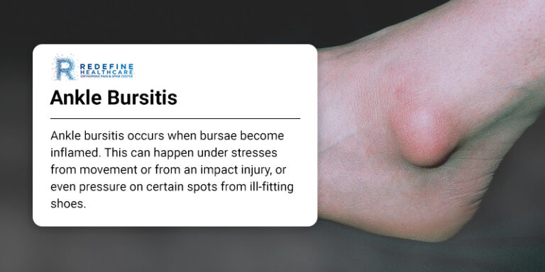Ankle Bursitis - NJ's Top Orthopedic Pain & Spine Practice in New Jersey