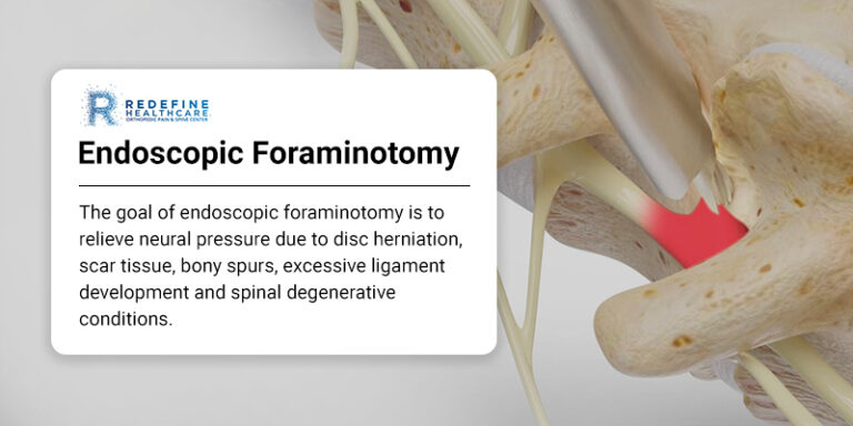 Endoscopic Foraminotomy Procedure | Back Pain Specialist in New Jersey