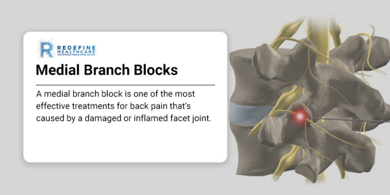 Medial Branch Blocks - NJ's Top Orthopedic Spine & Pain Management Center