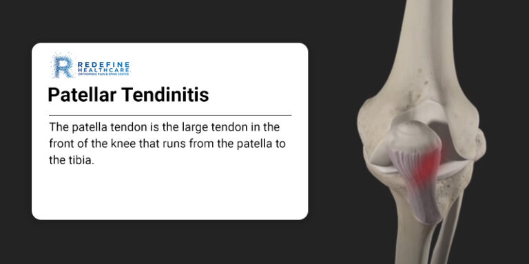 Patellar Tendinitis - NJ's Top Orthopedic Spine & Pain Management Center