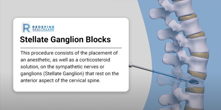 Stellate Ganglion Blocks - NJ's Top Orthopedic Spine & Pain Management ...