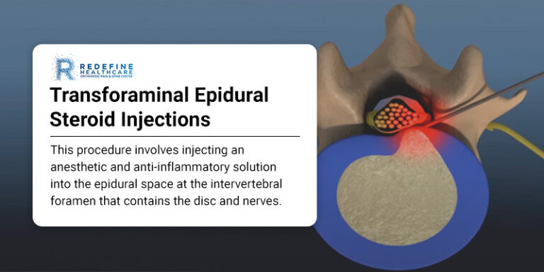 Transforaminal Epidural Steroid Injections NJ | Corticosteroids Injections