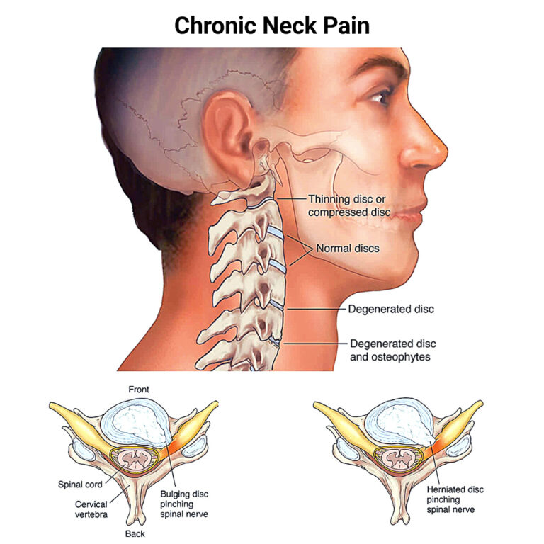 Why Chronic Neck Pain Should Never Be Ignored - NJ's Top Orthopedic ...