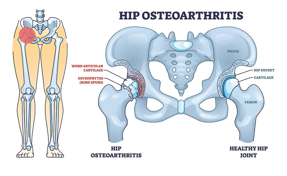 Hip Pain Doctors NJ | Hip Treatment Specialists New Jersey
